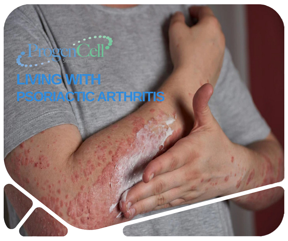 Living with psoriatic arthritis - Progencell